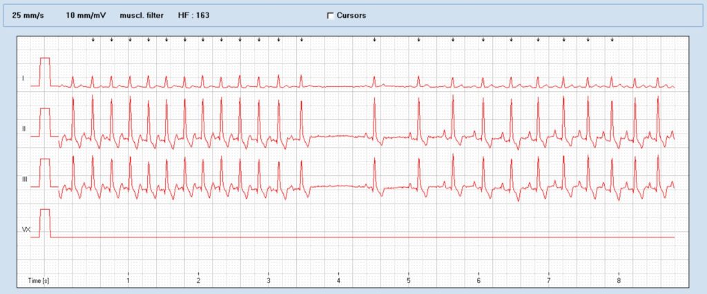 Paroxysmal supraventricular tachycardia in an old Bouvier – Vet ...