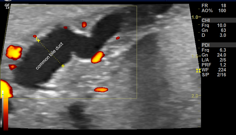 Aerobilia in a cat with extrahepatic biliary obstruction – Vet Practice ...