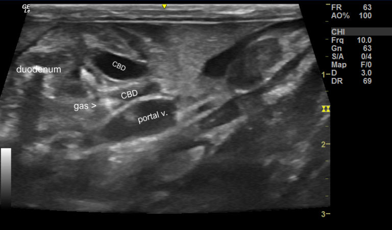Aerobilia in a cat with extrahepatic biliary obstruction – Vet Practice ...