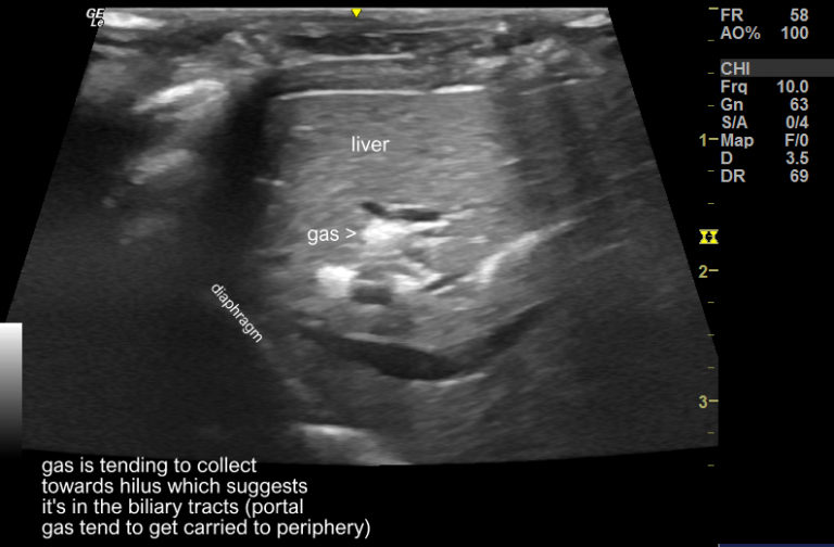 Aerobilia in a cat with extrahepatic biliary obstruction – Vet Practice ...