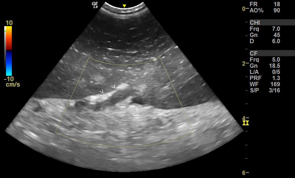 Splenic torsion….and the catchily-named hilar perivenous hyperechoic ...