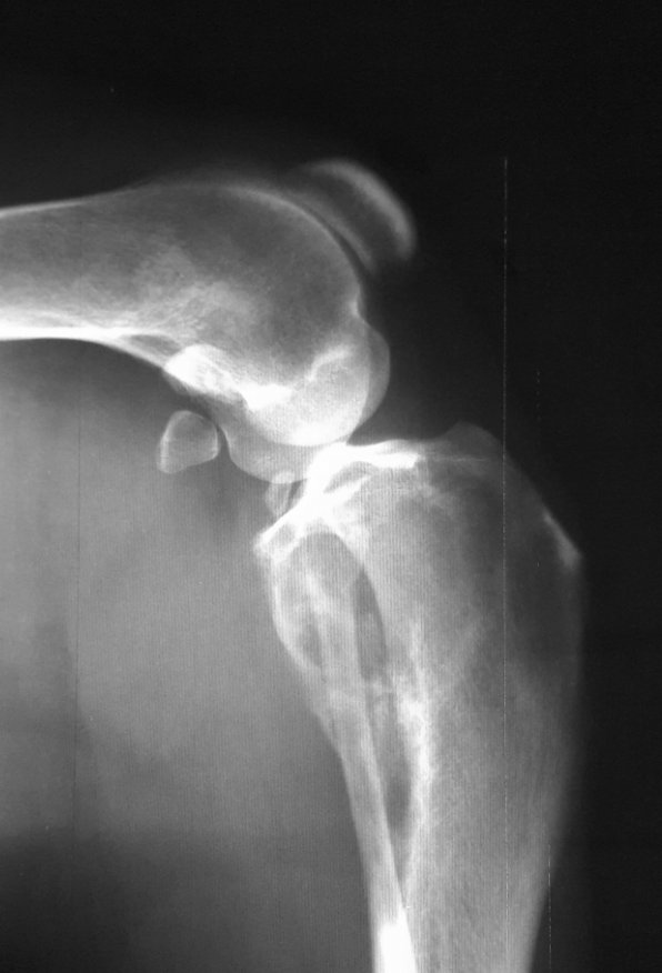 Percutaneous ultrasound-guided biopsy of bone tumours in dogs – Vet ...