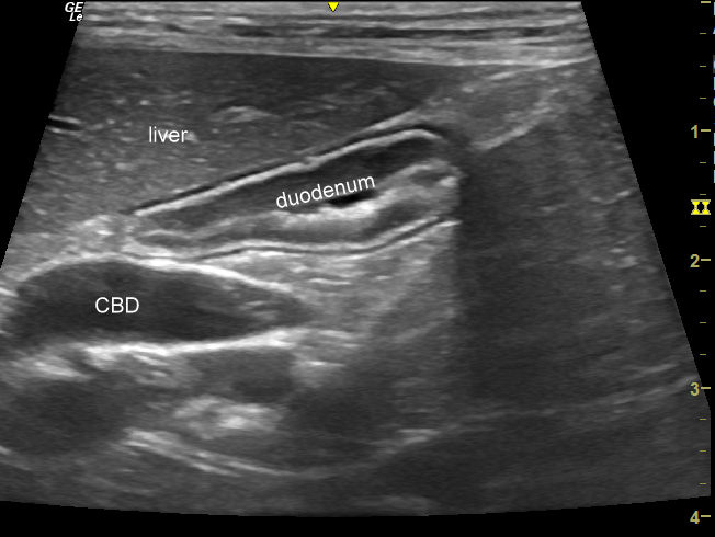 Re-formation of the gallbladder after cholecystectomy in a dog – Vet ...
