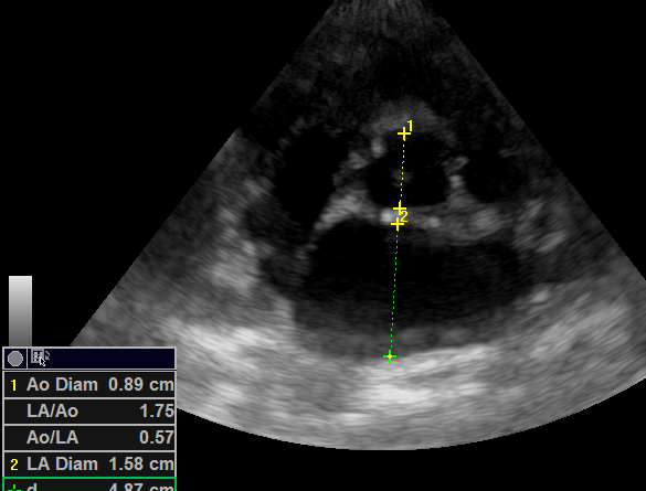 Why is this cat with a huge left atrium not in congestive failure ...