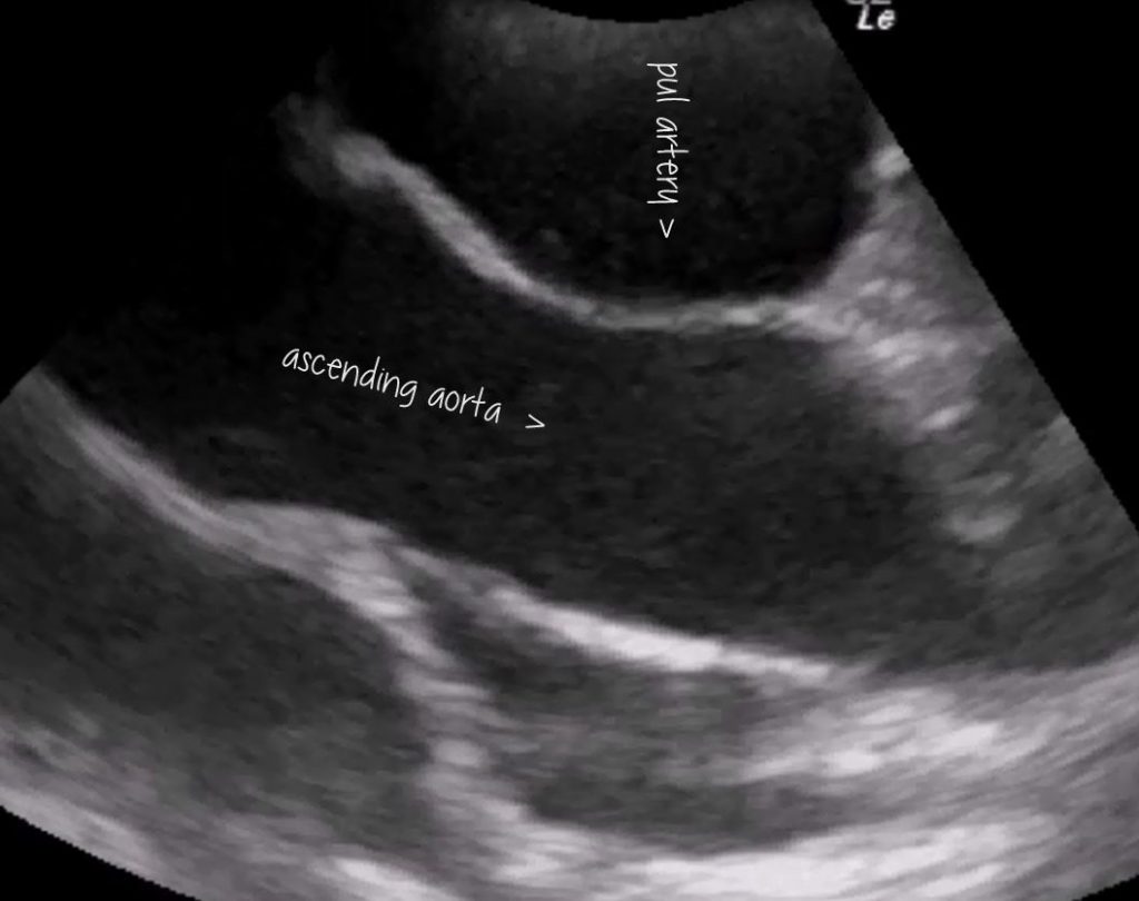 Canine patent ductus arteriosus (PDA) echocardiography – Vet Practice ...