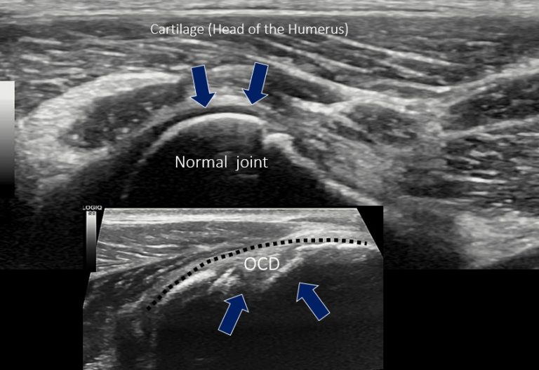 Sonographic features of canine shoulder osteochondrosis (OCD) – Vet ...