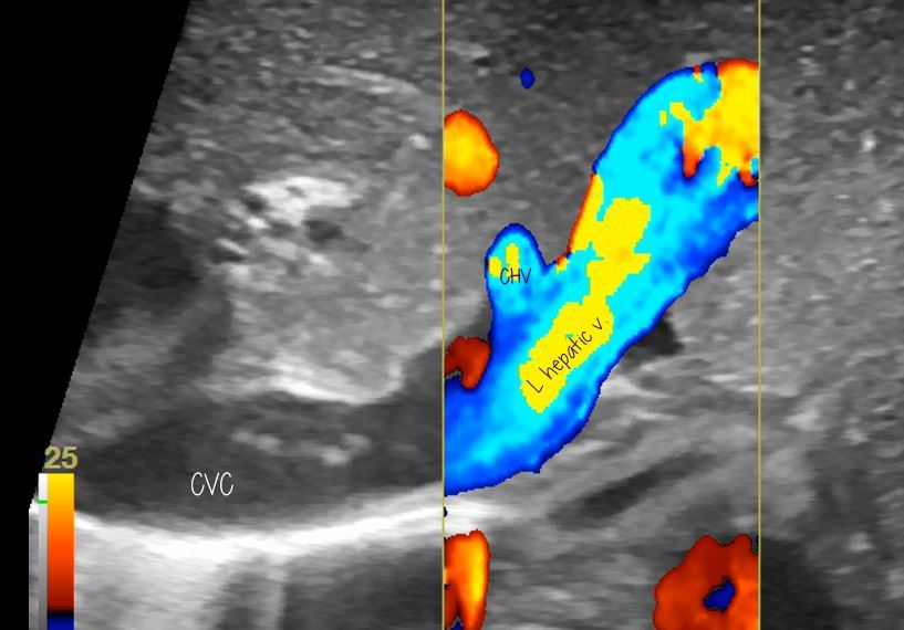 Intra-operative ultrasound: utility in intrahepatic shunt attenuation ...