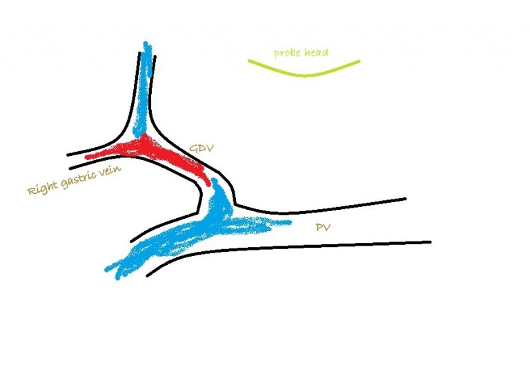 Should we recommend CT angiography for all potential portosystemic ...