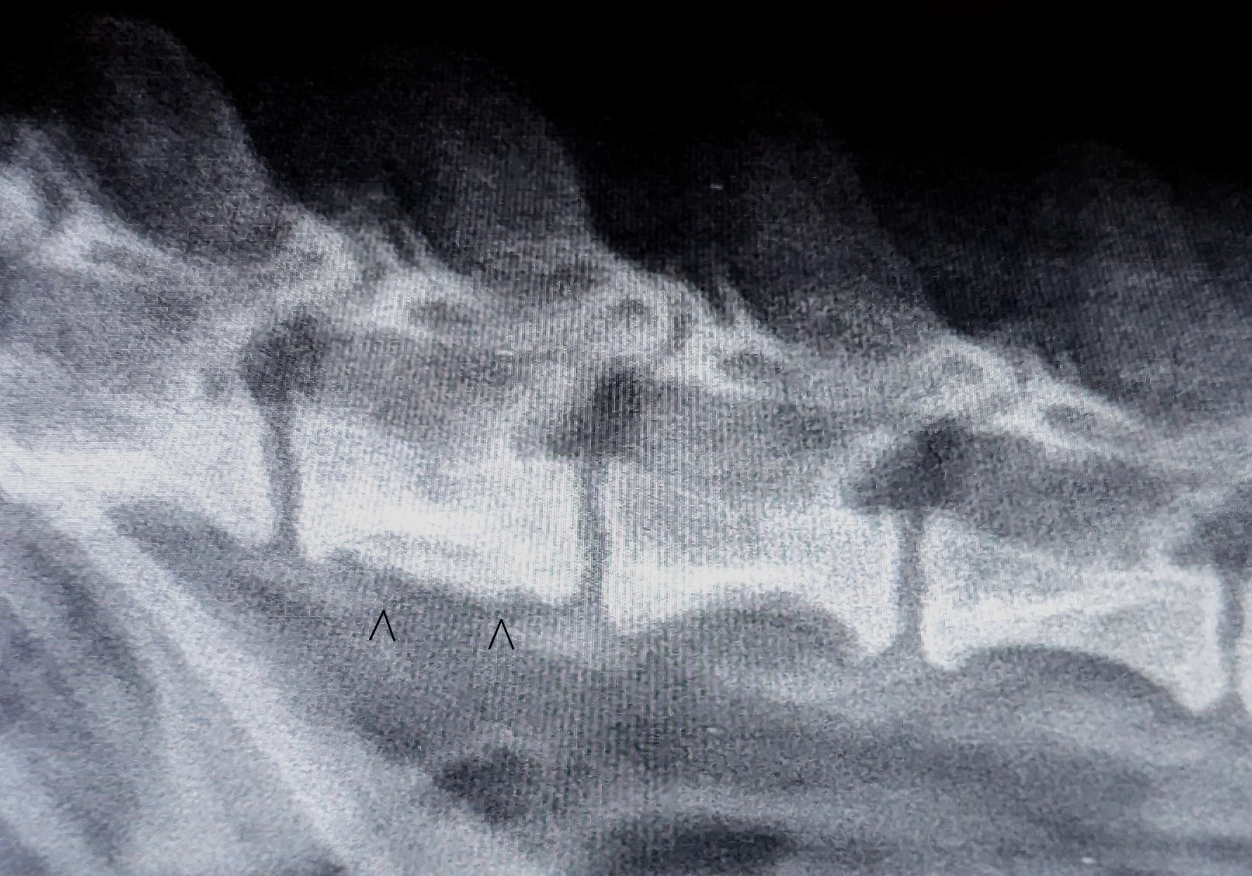 Sonographic features of bacterial discospondylitis in a dog – Vet ...